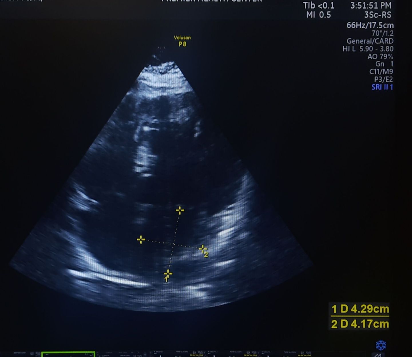 What is the relationship between Left atrial size and mitral “E ...