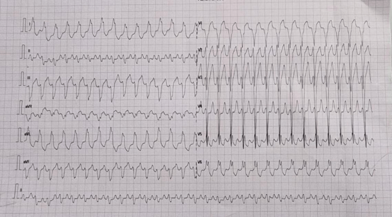 avr criteria | Dr.S.Venkatesan MD