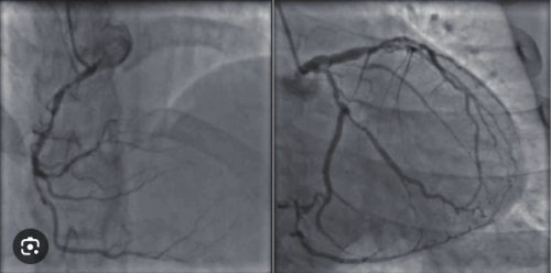 How to select a wrong patient for PCI, in stable multi vessel CAD ...