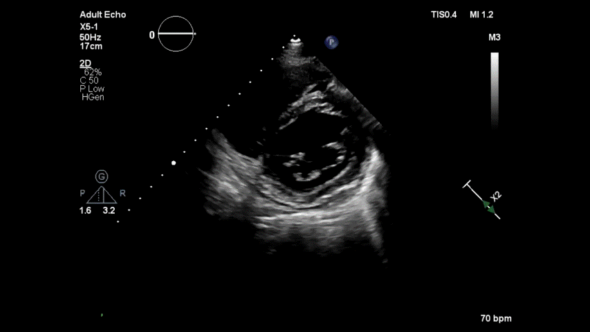 gun shot injury of heart | Dr.S.Venkatesan MD