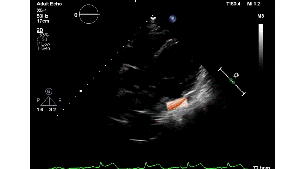 gun shot injury of heart | Dr.S.Venkatesan MD
