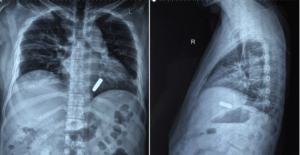 gun shot injury of heart | Dr.S.Venkatesan MD