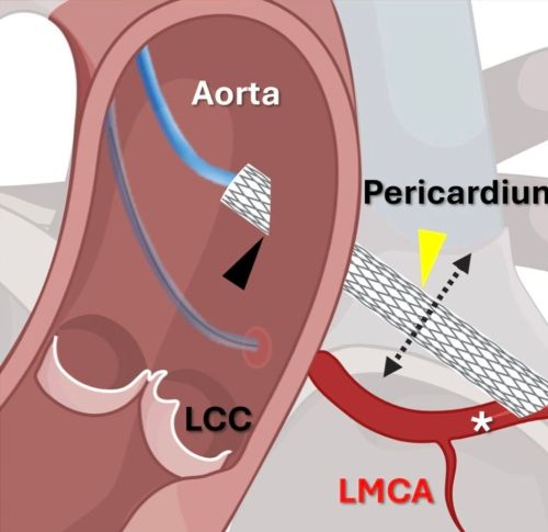 TACKLING CORONARY OBSTRUCTION AFTER TAVI | Dr.S.Venkatesan MD